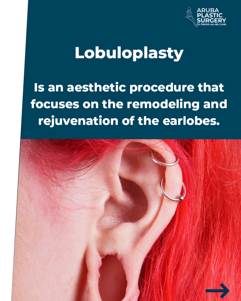 Lobuloplasty or Earlobe Repair at Aruba Plastic Surgery & Aesthetics ...