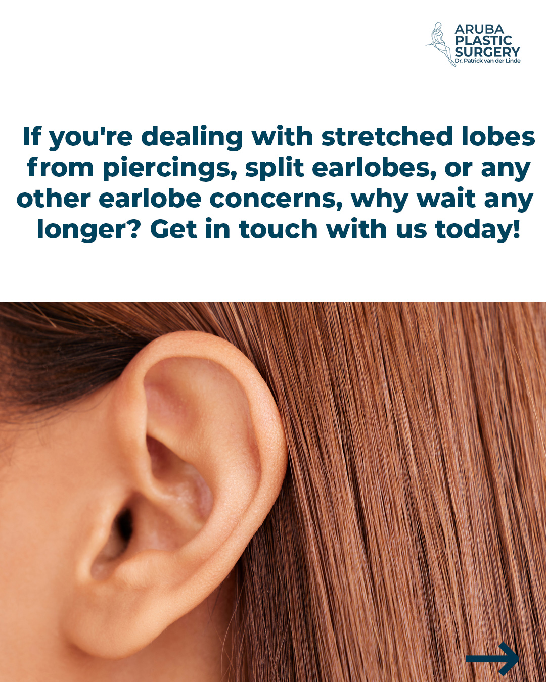 Lobuloplasty or Earlobe Repair at Aruba Plastic Surgery & Aesthetics ...